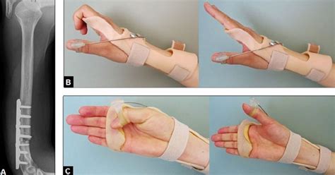 Median Nerve Palsy Splint