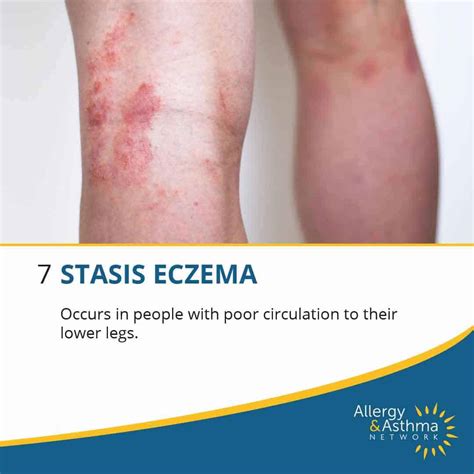 Eczema Bumps On Legs