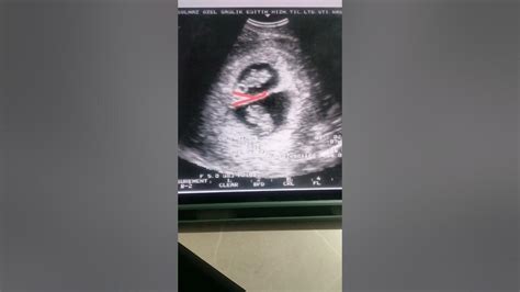 Lambda Sign Seen In Dichorionic Diamniotic Twin Radiological Youtube