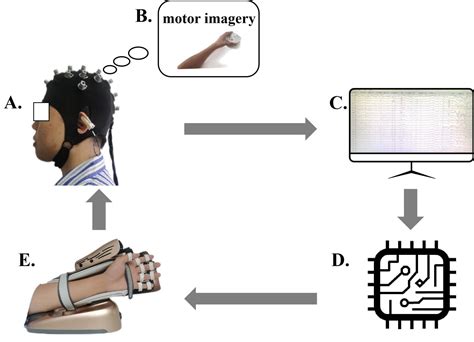 Motor Imagery Brain Computer Interface In Rehabilitation Of Upper Limb Motor Dysfunction After