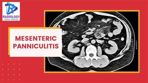 Mesenteric Panniculitis Sclerosing Mesenteritis Mesenteric