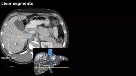 Liver Segment Anatomy Ct Scan Pptx