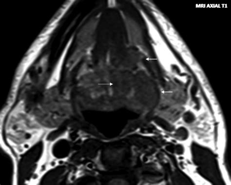 Mri Axial T1 Sequence Three Well Defined T1 Hypointense Lesions In Download Scientific