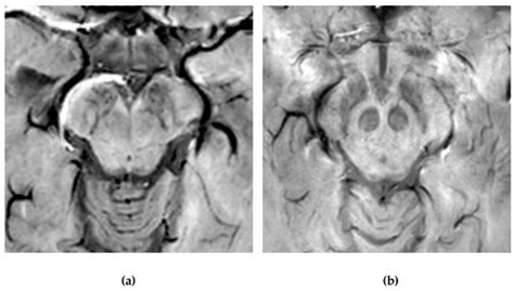 Substantia Nigra Imaging In Parkinson Encyclopedia Mdpi