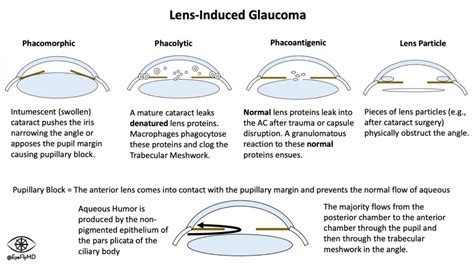 5 Types Of Lens Induced Glaucoma An Eye Care Blog