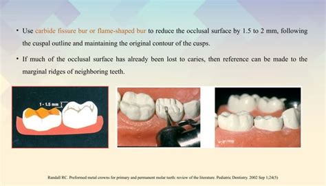 Stainless Steel Crowns In Pediatric Dentistry Pptx Dental Health