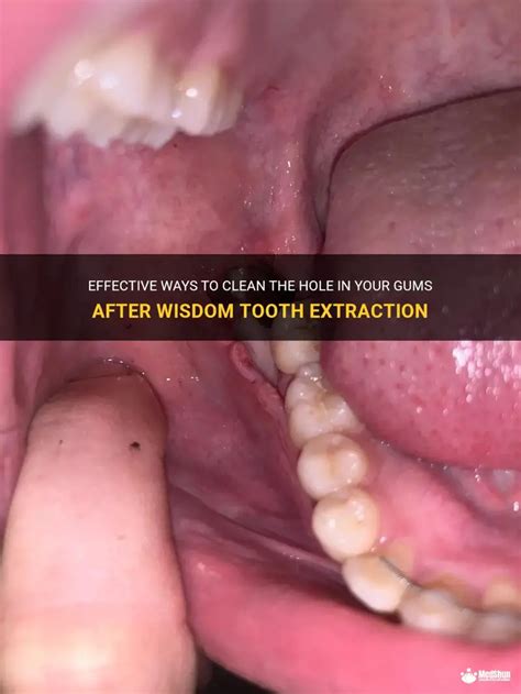 Effective Ways To Clean The Hole In Your Gums After Wisdom Tooth