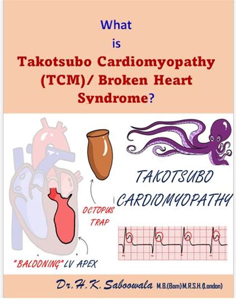 Takotsubo Cardiomyopathy Explained Broken Heart Syndrome 51 Off