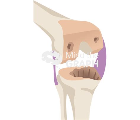 Total Knee Arthroplasty Revision Bone Loss2