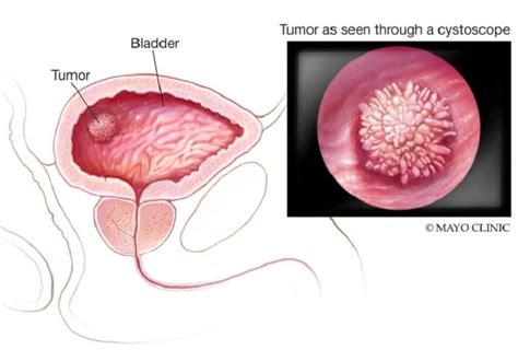 Bladder Cancer Tumor Removal