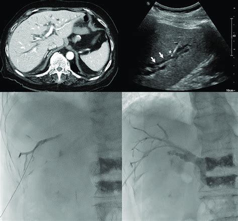 An 83 Year Old Woman With Jaundice Due To Distal Cholangiocarcinoma A