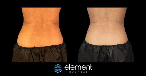 Coolsculpting Before And After Photos Element Body Lab
