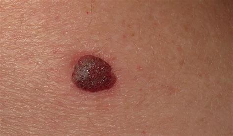 Clear Cell Acanthoma