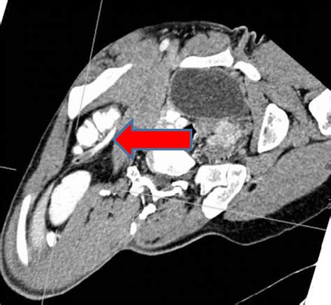 Classification Of Acute Appendicitis Caa Type 0 On Ct Normal Download Scientific Diagram