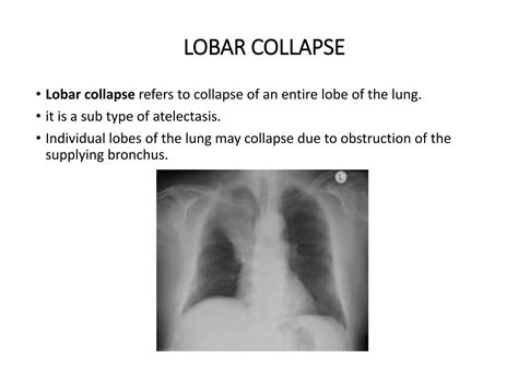 Lobar Collapse Xraypptx