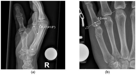Treatment Outcome Of 2nd To 5th Metacarpal Fractures Kirschner Wires Versus Intramedullary Screws