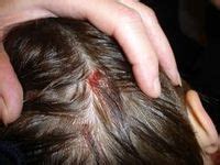 Incredible Sores On Scalp Ideas Sores On Scalp Scalps Soreness