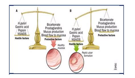 Pathophysiology Of Peptic Ulcer PDF