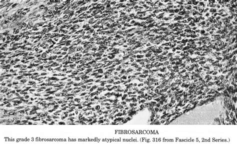 Pathology Outlines Fibrosarcoma Of Bone