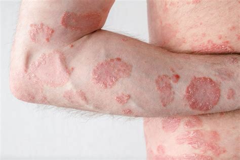 Psoriasis Treatment Chatham Skin Clinic