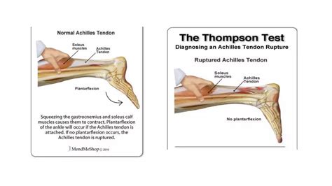 Ankle Injuries And Trimallelor Fracture Classification Pptx
