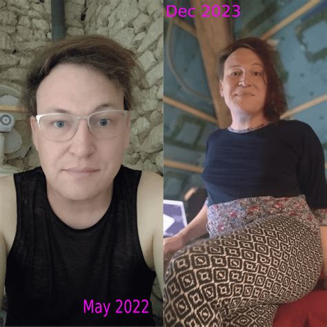 47 Years Old 1 Year And A Half Of Feminizing Hormonal Treatment Happy