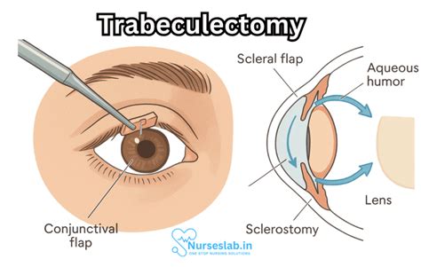 Trabeculectomy Nurseslab