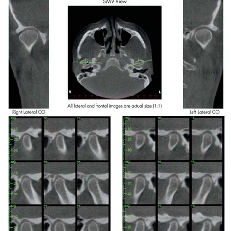 Abnormal Tmj Anatomy Tmj Disc Displacement With Reduction Adapted From