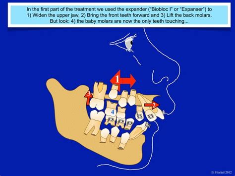 De Extraction Explanation Ppt