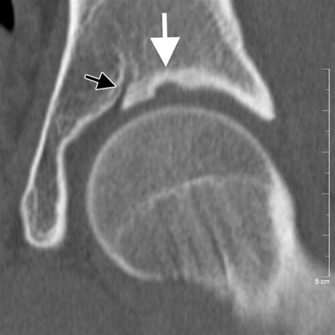 Acetabular Fossa