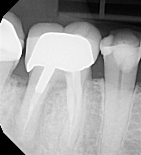 Socket Graft Plus Vs Allograft Allografts Never Resorb