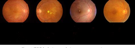 Table 1 From Detection Of Microaneurysms In Fundus Images Based On An