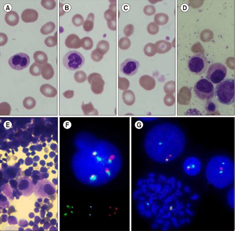 A C Peripheral Blood Film Shows Significant Dysgranulopoiesis In The