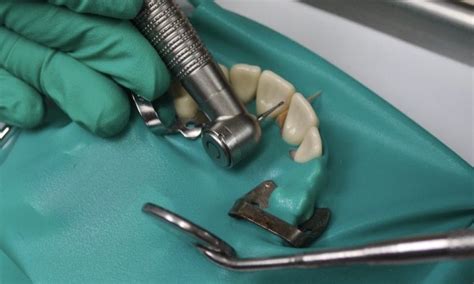 Class Iii Composite Preparation My Dental Key