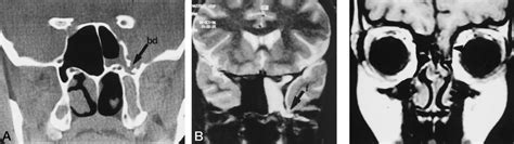 T1 Weighted Coronal Mr Image Shows Presence Of Herniated Gyrus Rectus