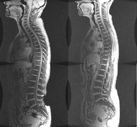 Figure 1 3 From Automated Vertebra Segmentation And Quantification