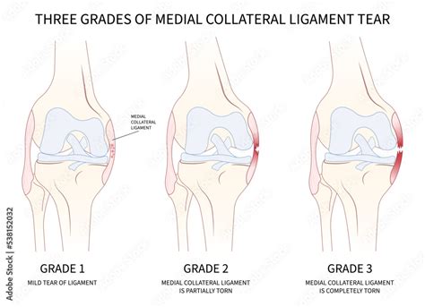 Poster Classification Of Medial Collateral Ligament Injury Test