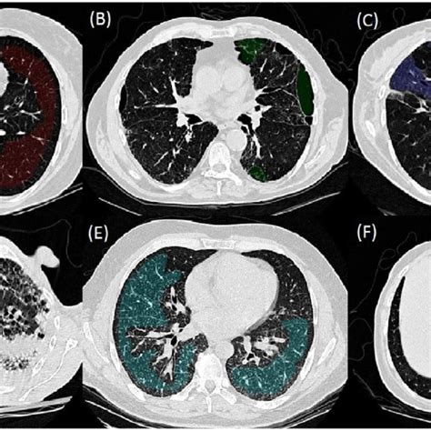 Pdf Holistic Classification Of Ct Attenuation Patterns For