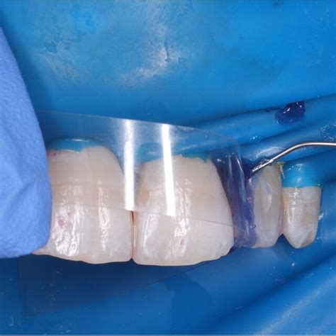 Enamel Etching For Conventional Celluloid Matrix Group Download Scientific Diagram