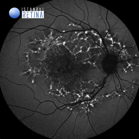 54 Choroidal Neovascular Membrane Secondary To Pattern Dystrophy