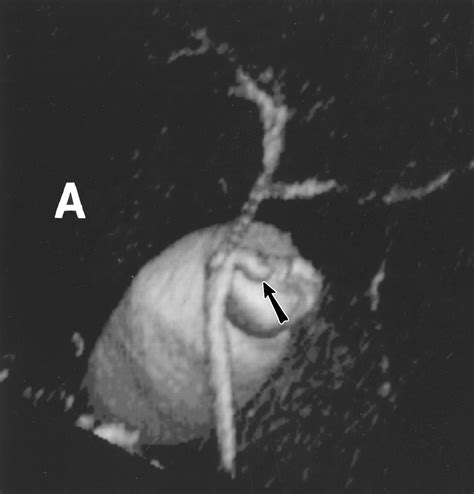 Helical Ct Cholangiography With Three Dimensional Volume Rendering Using An Oral Biliary