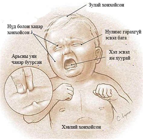 Суулгалт өвчний илрэх шинж тэмдэг урьдчилан сэргийлэх аргууд Asuudal Mn