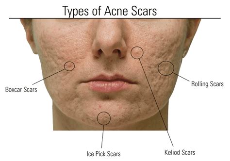 Acne Scars Types Of Acne Scarring And Ideal Treatments