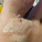 Filiform Wart On Eyelid Has Been Small Unchanged For Over A Decade R Warts
