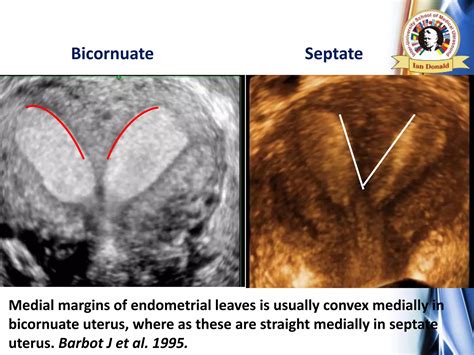 3d 4d Ultrasound In Uterine Septum Evaluation Pptx