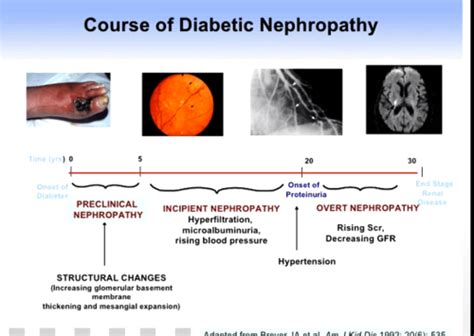 Diabetic Nephropathy Flashcards Quizlet