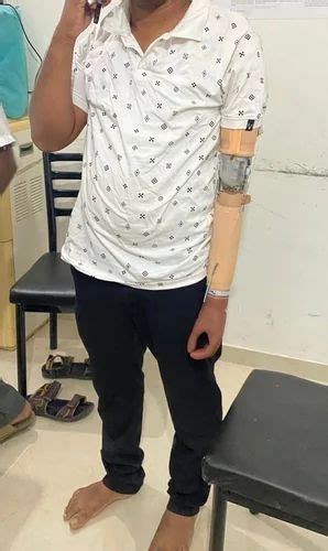 Hand Transhumeral Prosthesis At ₹ 80000 Piece In Thane Id 2855615284897