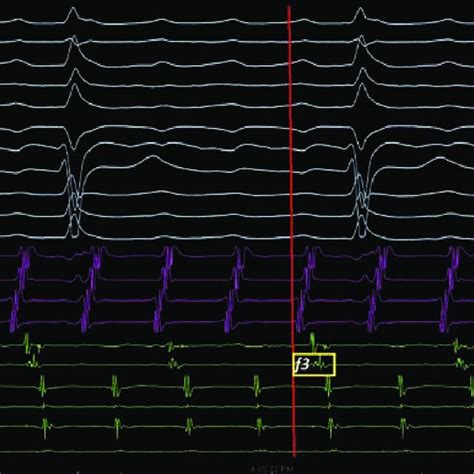The Relationship Of F1 And F2 Fragmented Signals With P Wave Onset Download Scientific Diagram