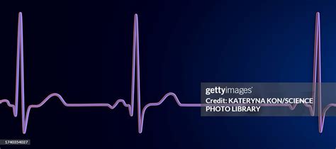 Sinus Arrhythmia Heartbeat Rhythm Illustration High Res Vector Graphic