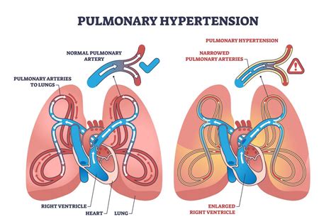 What Is Pulmonary Hypertension Northside Hospital